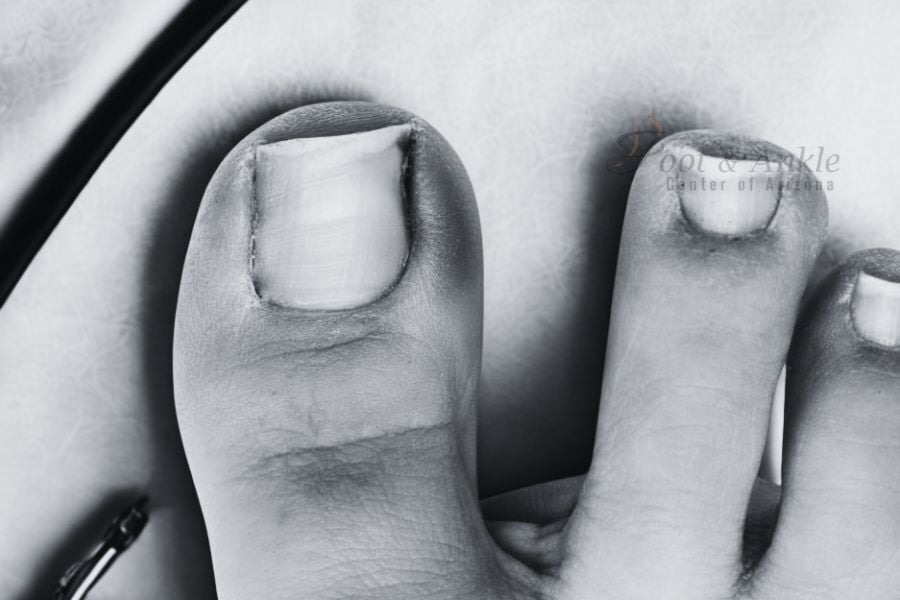 How to Straighten Curved Toenails - Foot & Ankle Center of Arizona