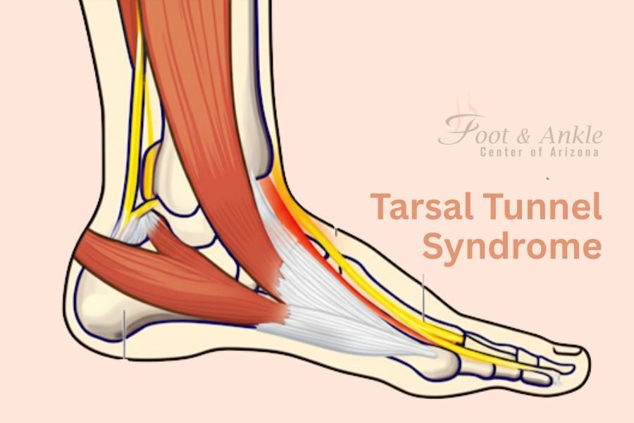 Tarsal Tunnel Syndrome - Foot & Ankle Center of Arizona