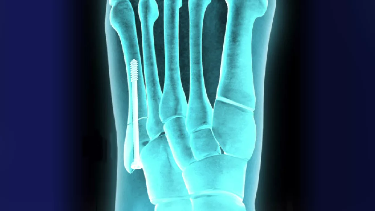 Jones Fracture Fixation: Pain Management and Healing Guide