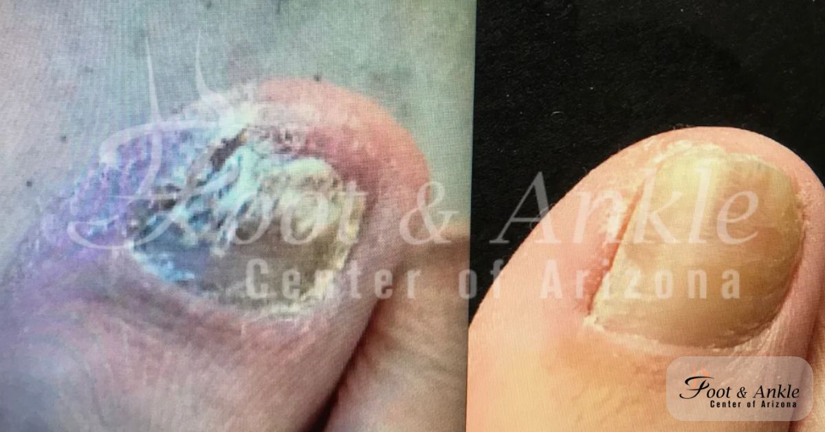 Toenail Cracked in Half? Causes, Treatments, How to Fix It Safely?