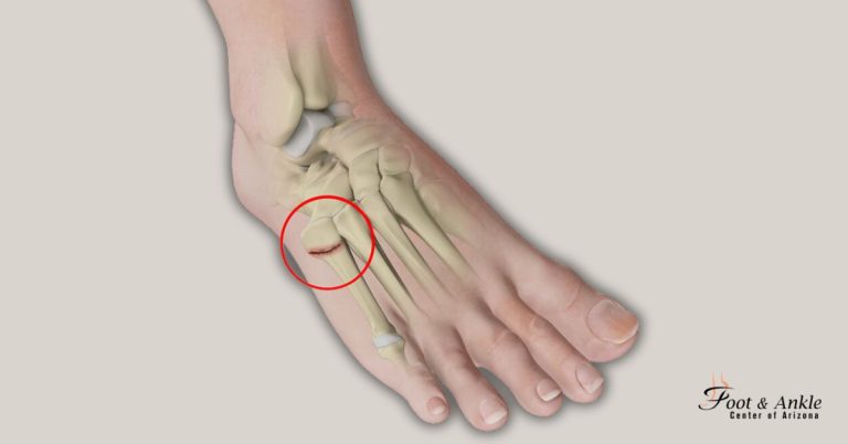 How long does it take for a Metatarsal Fracture to Heal? - Foot ...
