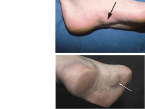 What Does a Plantar Fibroma Look Like? Causes, Symptoms